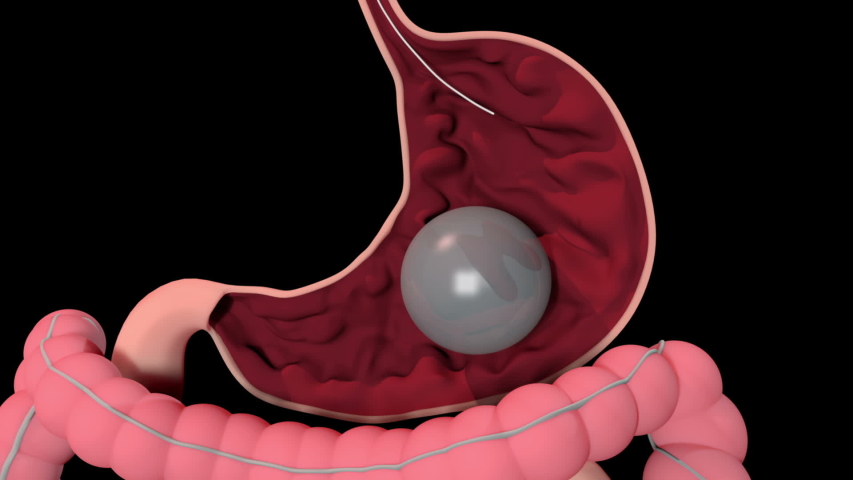 148 Stomach Balloon Stock Video Footage - 4K and HD Video Clips ...