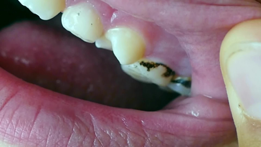 A Childs Neglected Teeth Covered Stock Footage Video (100% Royalty-free ...