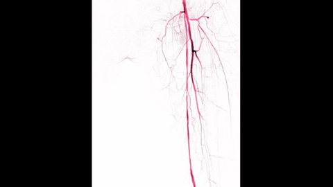 Angiogram Left Femoral Artery Showing Vessel Stock Footage Video (100% ...