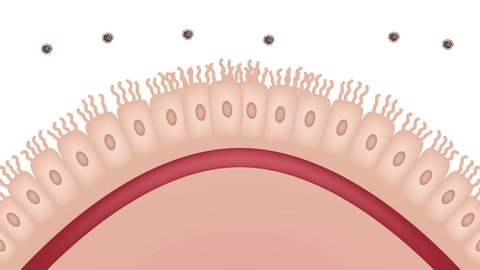 Celiac Disease Small Intestine Lining Damage Stock Vector (Royalty Free ...