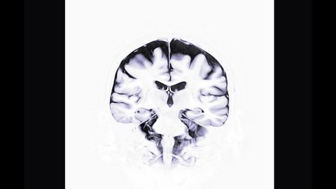 Mri Brain Coronal View Negative Filter Stock Footage Video (100% ...