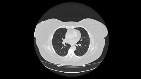 Mri Scan Lungs Bronchi Diagnosis Respiratory Stock Footage Video (100% ...