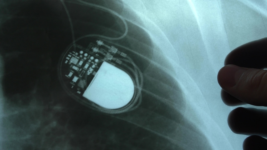 22 Pacemaker implantation Stock Video Footage - 4K and HD Video Clips ...