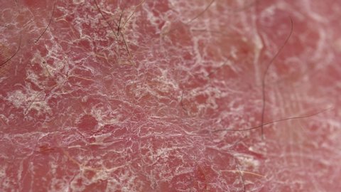Unhealthy Human Skin Epidermis Texture Flaking Stock Photo (Edit Now ...