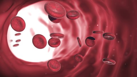 Blood Clot Calcified Lesion Plaque Artery Stock Illustration 93504403