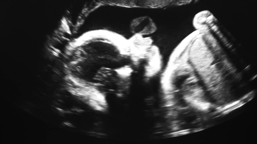 Happy future mother watching pregnancy ultrasound photos. Slow Motion ...