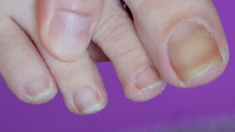 Female Overgrown Long Unclipped Toenails Close Stock Footage Video (100 ...