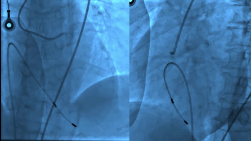 Trans Venous Pacing Stock Video Footage - 4K and HD Video Clips ...