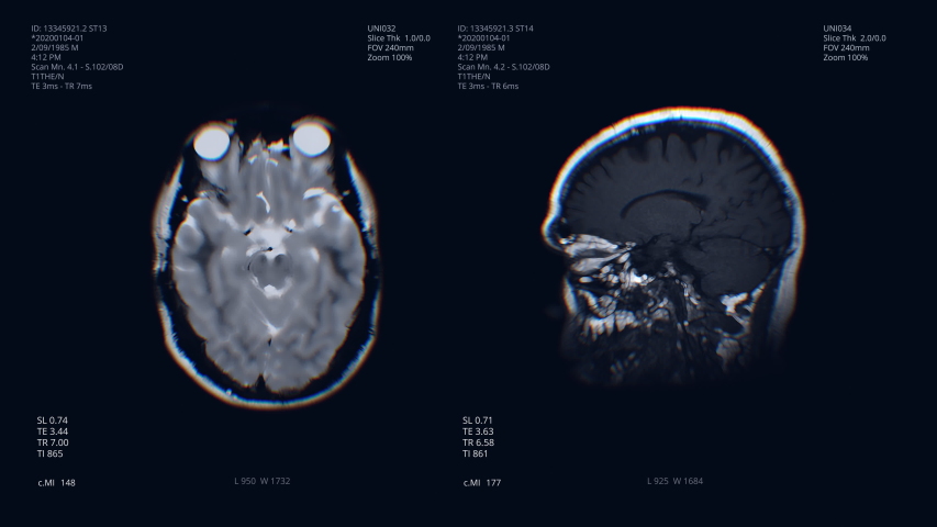 Brain Scan Visualization Footage. Diagnosis Stok Videosu (%100 Telifsiz ...