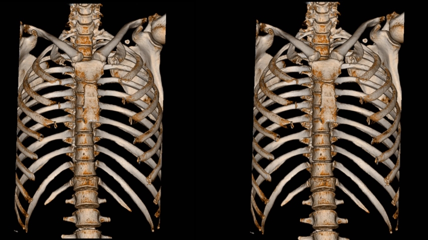 Thoracic Thorax Stock Video Footage - 4K and HD Video Clips | Shutterstock