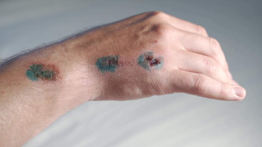 Cleaning Infected Wound On Arm Stock Footage Video (100% Royalty-free ...