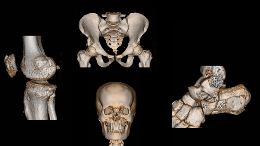 Ct Scan 3d Render of Stock Footage Video (100% Royalty-free) 1053385217 ...