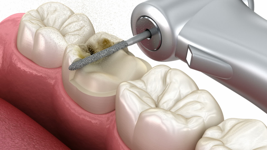 58 Inlays Onlays Stock Video Footage - 4K and HD Video Clips | Shutterstock