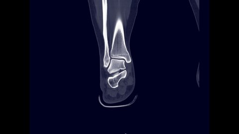 Ct Foot Coronal View Diagnosis Fracture Stock Footage Video (100% ...