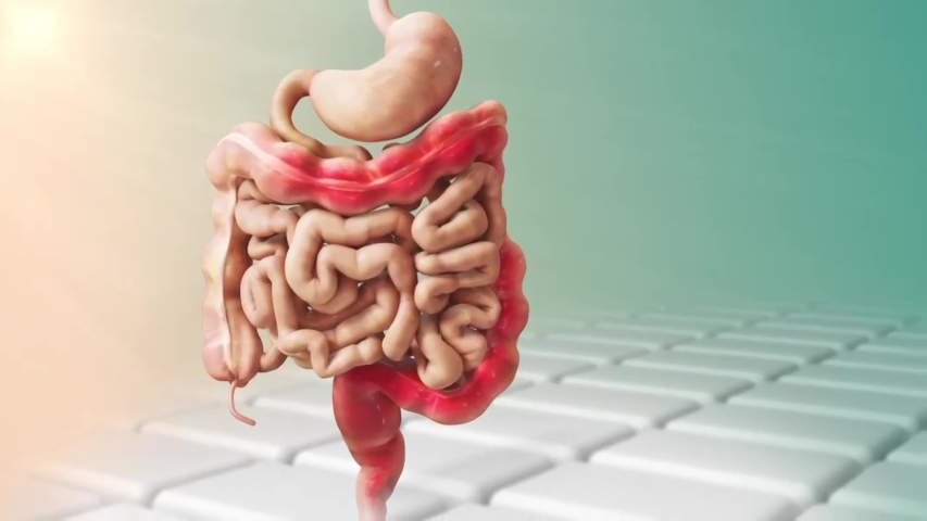 Sigmoid colon cancer Stock Video Footage - 4K and HD Video Clips ...