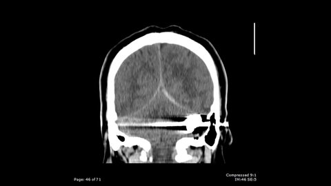 Ct Scan Coronal View Bullet Fragmentation Stock Footage Video (100% ...