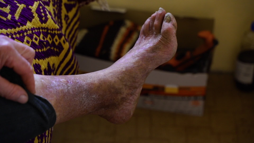 Very Sick Leg Old Man Stok Videosu (%100 Telifsiz) 1054726691 ...