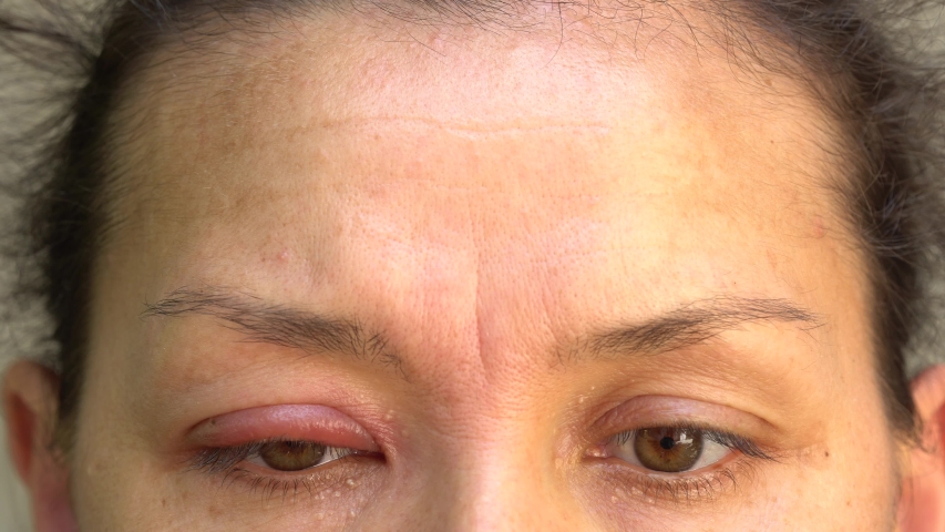 Stye Stock Video Footage - 4K and HD Video Clips | Shutterstock