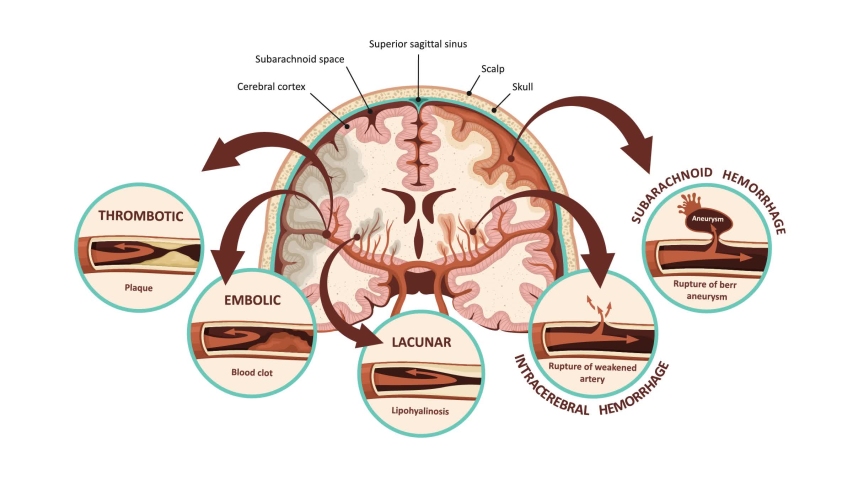 Migraine Anatomy Stock Video Footage - 4K and HD Video Clips | Shutterstock