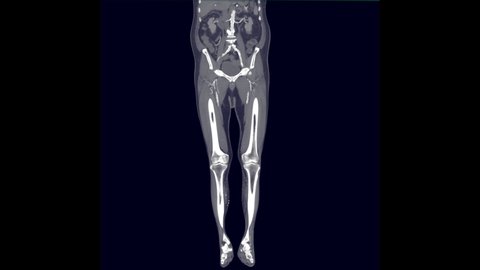 Ct scan leg Stock Video Footage - 4K and HD Video Clips | Shutterstock