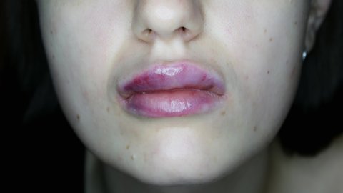 Closeup Swollen Lips After Injections Hyaluron Stock Footage Video (100 ...