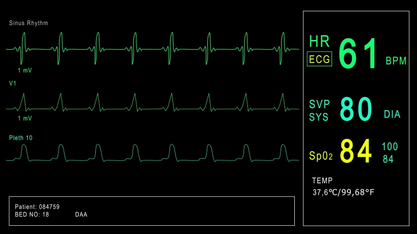 monitoring patient vital signs heart rate Stock Footage Video (100% ...