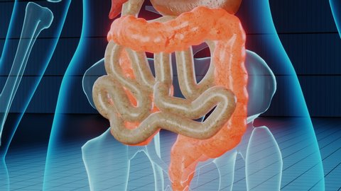 Damaged Failed Large Intestine Human Body Stock Footage Video (100% ...