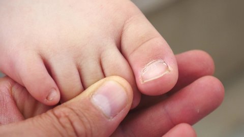 Paronychia Swollen Finger Fingernail Bed Inflammation Stock Photo (Edit ...