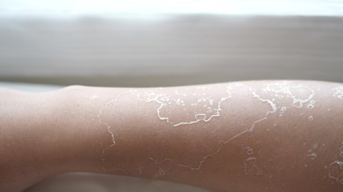 Dermatitis On Arm Hand Peeling Dead Stock Footage Video (100% Royalty ...