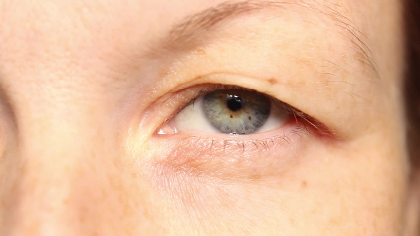 Swollen eye Stock Video Footage - 4K and HD Video Clips | Shutterstock