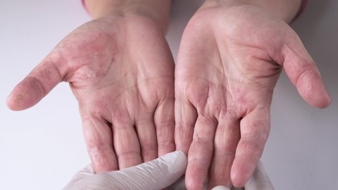 Pallor Anaemia Comparing Normal Anaemic Hands Stock Photo 1127849051 ...