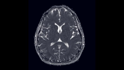 Mri Brain Axial View Dwi Technique Stock Footage Video (100% Royalty ...