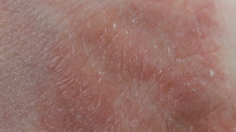 hydration process dark dull flaky skin Stock Footage Video (100% ...