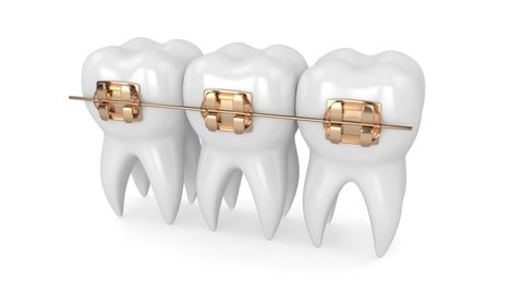 Teeth Golden Orthodontic Braces Stock Footage Video (100% Royalty-free ...