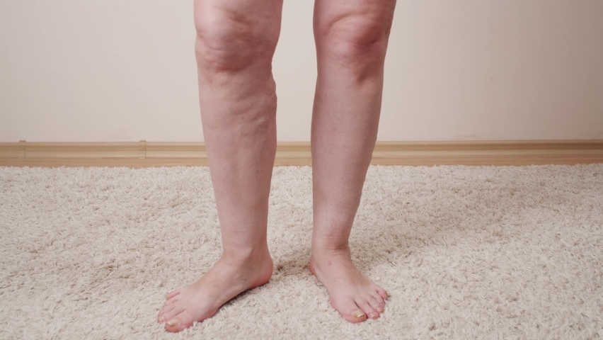 patients legs old woman varicose veins Stock Footage Video (100% ...