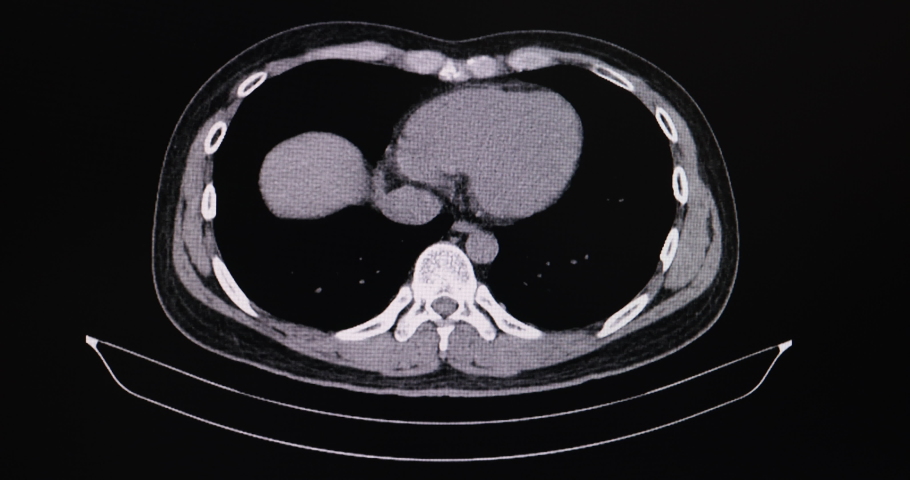 Gall Stone Stock Video Footage - 4K and HD Video Clips | Shutterstock