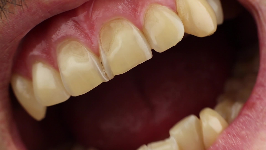 Wedge Shaped Defect Stock Video Footage - 4K and HD Video Clips ...