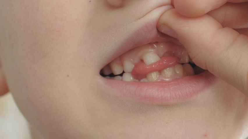 Close-up of a small boy showing his fallen baby tooth. Close-up of ...