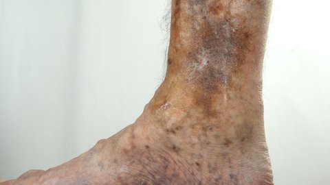 Human Hands Touch Crumple Sore Spotty Stock Footage Video (100% Royalty ...