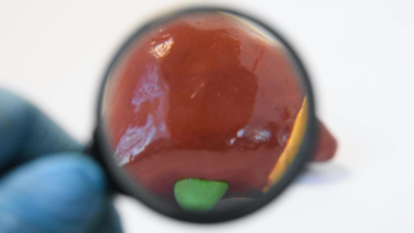 Gallbladder removal Stock Video Footage - 4K and HD Video Clips ...