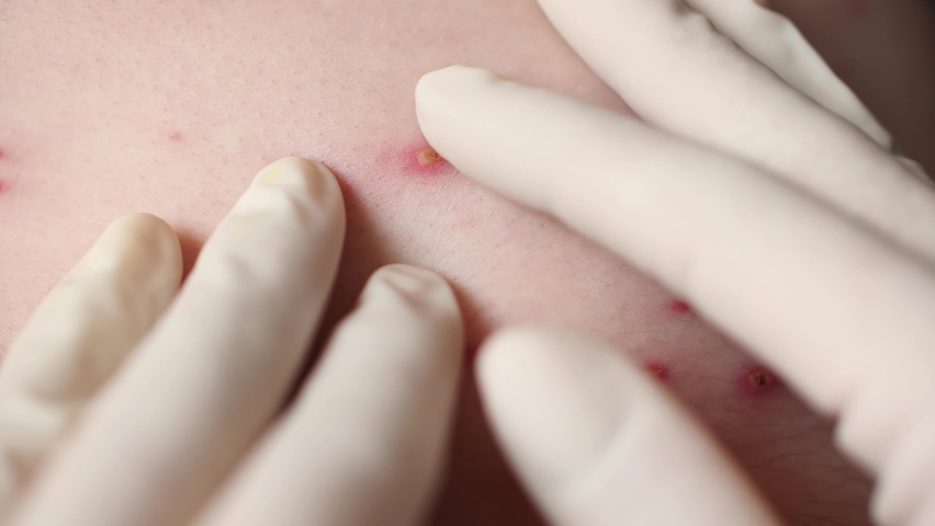 lubricate with zinc ointment from suppuration during chickenpox in a ...