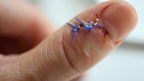 Wound Stitches On Finger Treated Antiseptic Stock Footage Video (100% ...