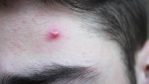 Ringworm Tinea On Head Asian Woman Stock Photo (Edit Now) 1500115235
