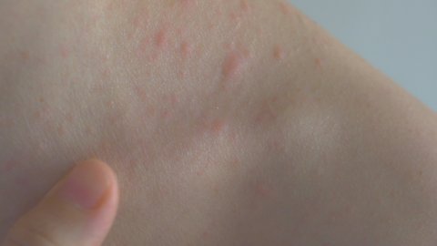 Infected Sebaceous Cyst Punctum Treatment By Stock Photo (Edit Now ...