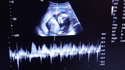 Ultrasound Scan Baby Heart Beat Stock Footage Video (100% Royalty-free ...
