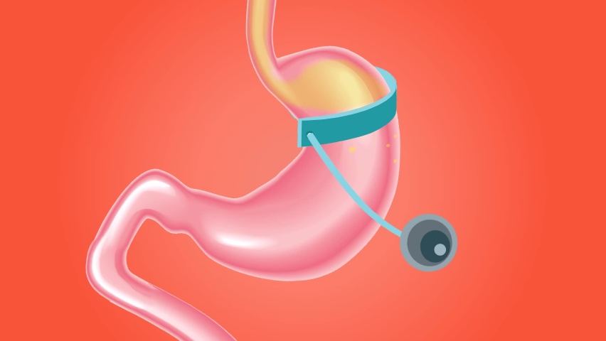 40 Gastric Sleeve Surgery Stock Video Footage - 4K and HD Video Clips ...