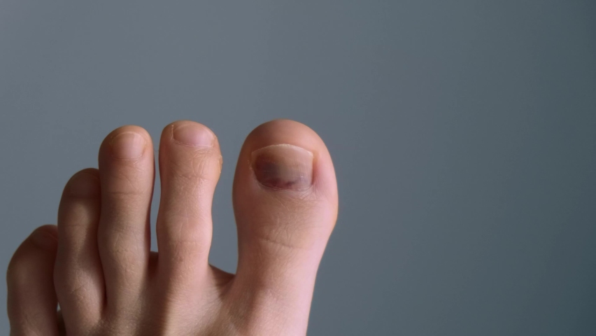woman's foot injury nail due wearing Stock Footage Video (100% Royalty ...