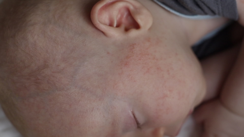 Allergy Atopic Dermatitis Eczema Rash Stock Footage Video (100% Royalty ...