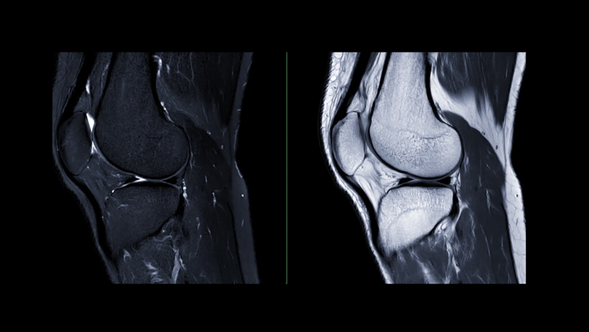 Crossed joints Stock Video Footage - 4K and HD Video Clips | Shutterstock