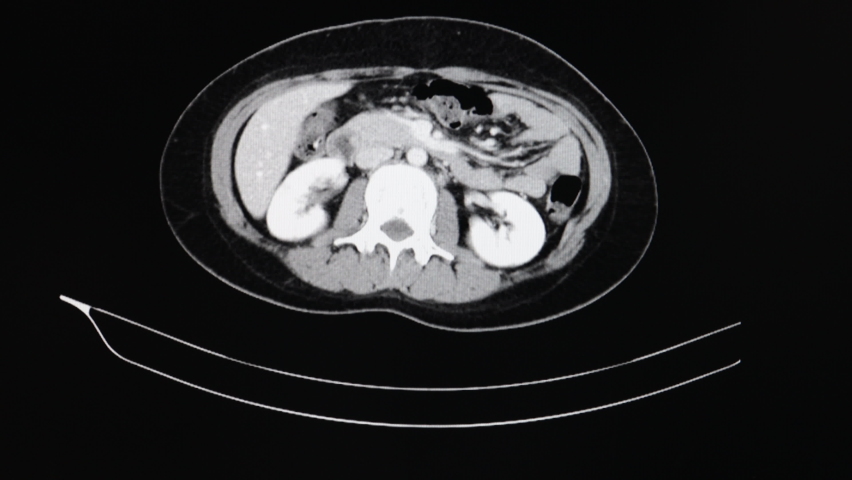 Appendicitis Diagnosis Stock Video Footage - 4K and HD Video Clips ...